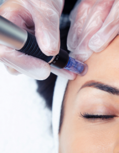 DermaPen & PRP – Dr Mary Mackenzie